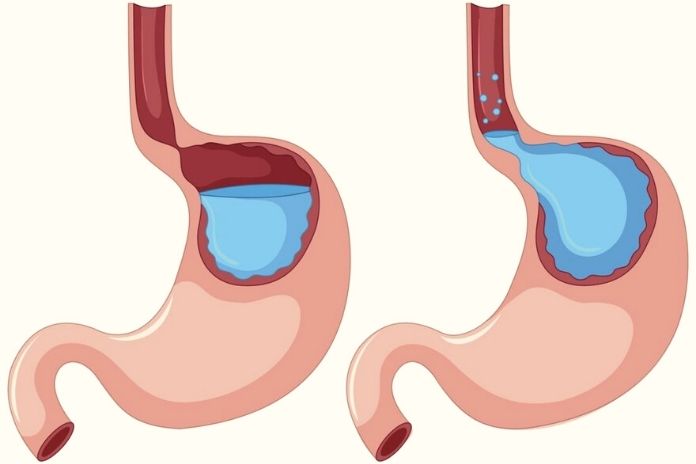 Gastric Reflux Disease (GERD): Causes And Treatments
