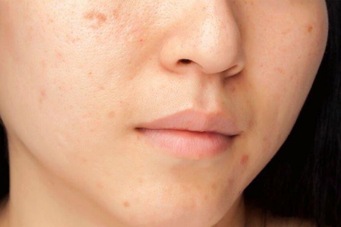 Late Acne: Causes And Tips For Bad Skin From 25