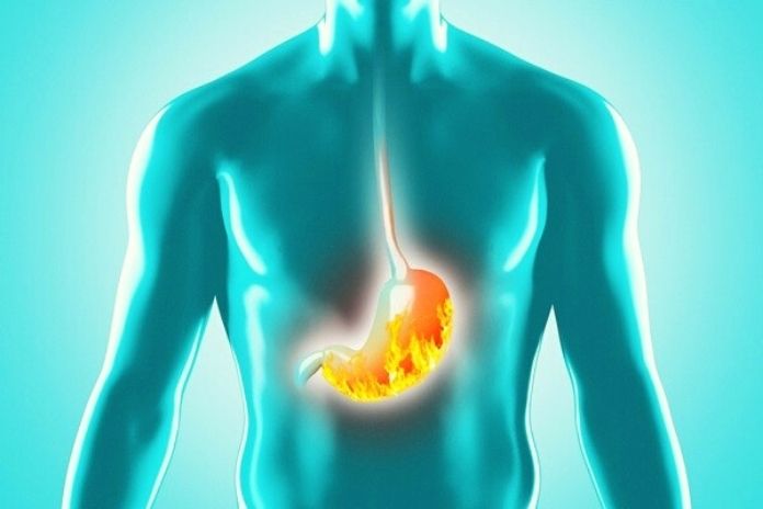 Gastroesophageal Reflux: Causes, Symptoms, Tests For Treatment