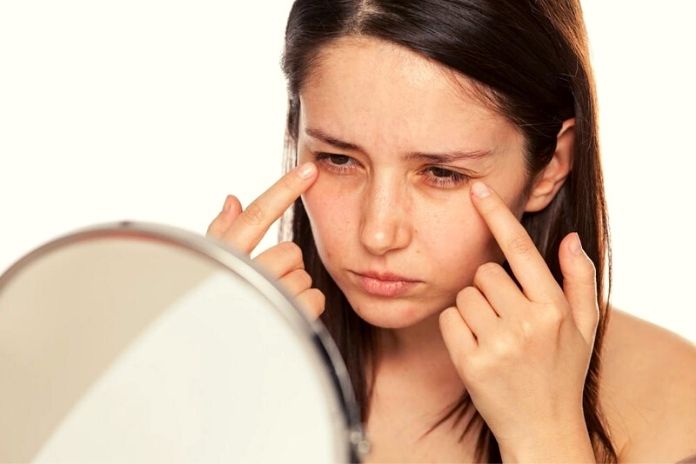 How To Get Rid Of Dark Circles: Natural DIY Remedies
