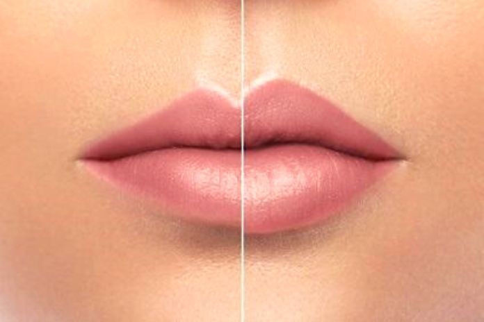 PRP Injections For The Lips