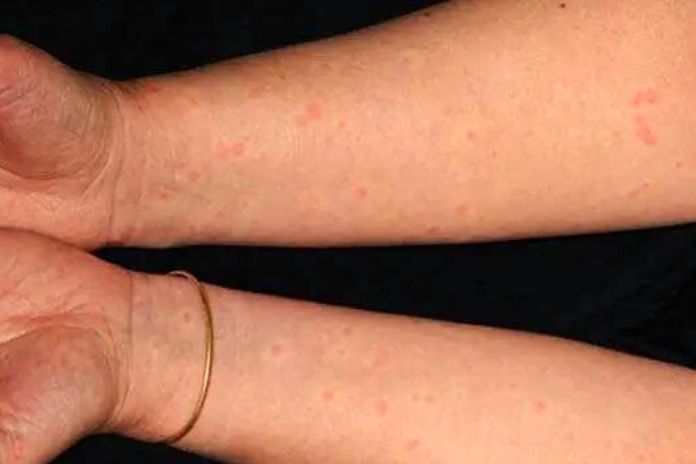 Urticaria: A Most Often Inflammatory Disease
