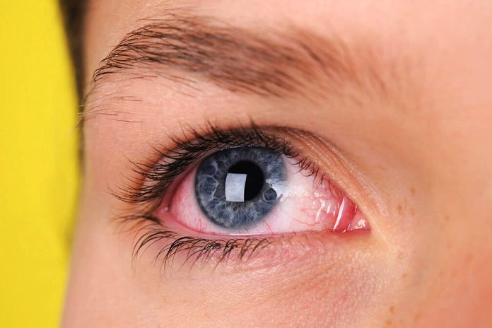 How To Treat Red Eyes