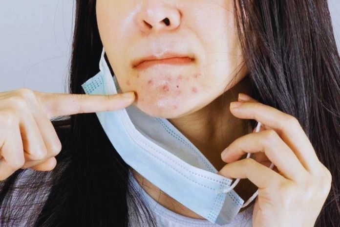 How To Prevent Mask Irritation
