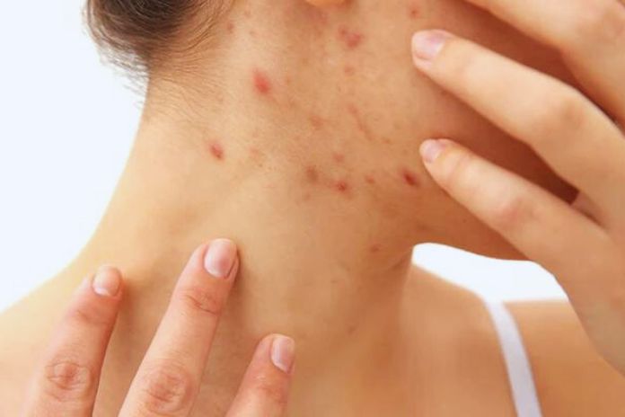 Red Spots On The Skin: Symptoms, And Possible Remedies